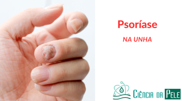 Psoríase na unha: causas, sintomas e tratamentos - Ciência da Pele